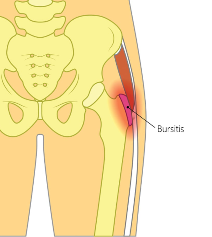 Bursitis trochanterica | Orthoclinic - Orthopedie Brugge